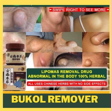Lipoma Removal Cream Treat Tumor Skin Swelling Ointment Herbal Remove