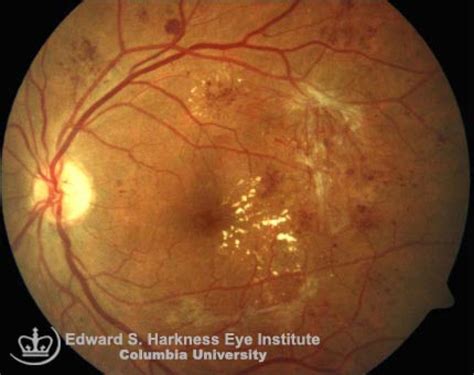 Proliferative Diabetic Retinopathy Pdr Vagelos College Of