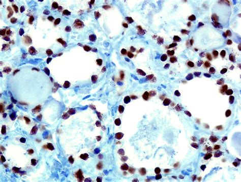 Pathology Outlines Follicular Thyroid Carcinoma