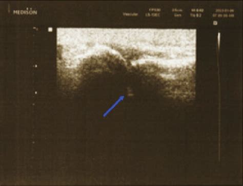 Needle Inside Mtp Joint Download Scientific Diagram