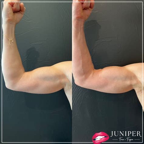 Before And After Gallery Juniper Face Figure