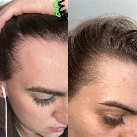 6 Months Of Accutane Before And After Hair Loss Side Effect Tried To