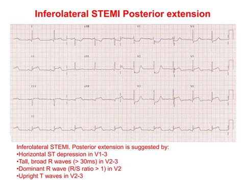 St Segment In Ecg St Elevation And St Depression Pptx