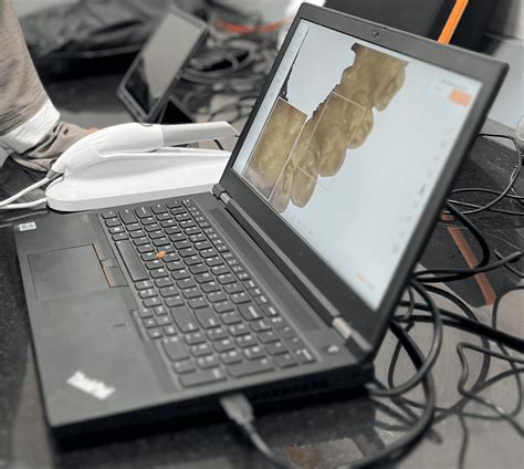 Digitalisation In Impression Techniques Intra Oral Scanning Karnavati University