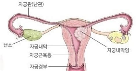 또 다른 세상 자궁 내막암 수술 후 5년차