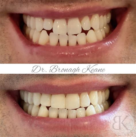 Dr Bronagh Keane On Linkedin Compositebonding Smilemakeover