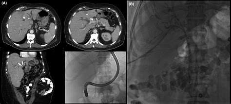 Surgical Management Of Hilar Cholangiocarcinoma At Memorial Sloan Kettering Cancer Center