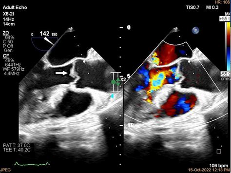 2d Tee In Long Axis View In Systole Color Study Revealed Mild To