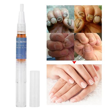 Fungal Nail Treatment 3ml Onychomycosis Repair Liquid For Finger And