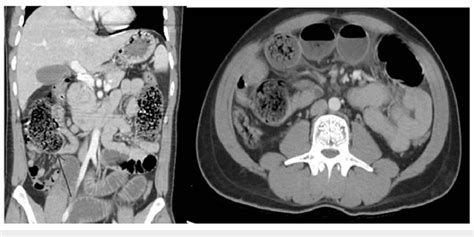 Abrupt Cut Of Small Bowel At Distal Ileum With Dilated Fecal Loaded As