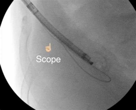 Non Surgical Gallstone Removal Cholangioscopy Technique