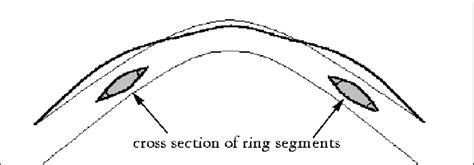 Intrastromal Corneal Ring Segments Download Scientific Diagram
