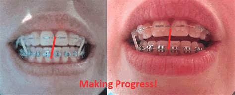 Overbite Braces Rubber Bands