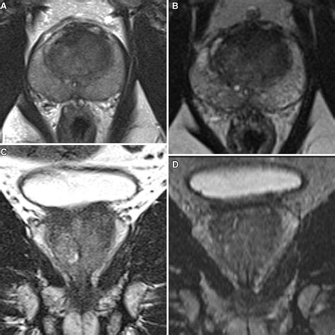 Multiparametric Prostate Mri Focus On T2 Weighted Imaging And Role In