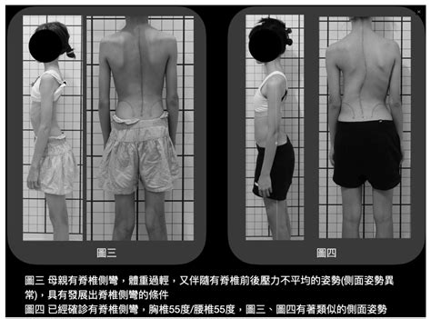 脊柱侧弯有哪些症状？可以通过哪些征兆自测？ 知乎