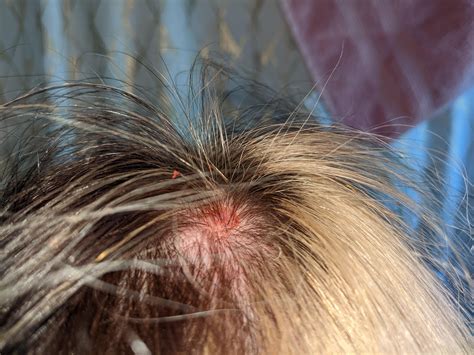 Cant Stop Picking My Scalp R Compulsiveskinpicking