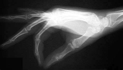 Standard Xray Views Lateral Hand