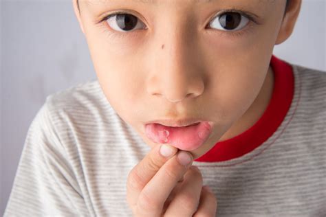 Afte Quale Terapia Efficace Farmacommunity