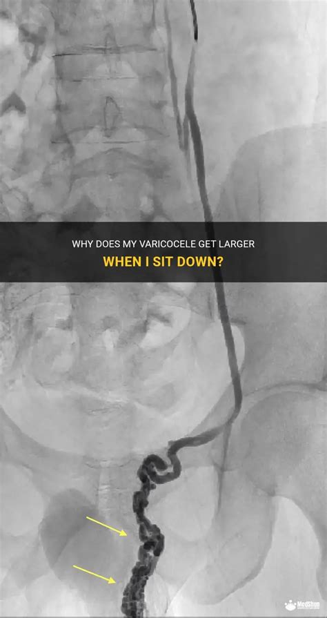 Why Does My Varicocele Get Larger When I Sit Down Medshun