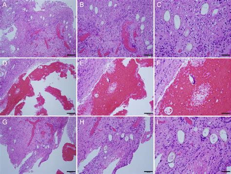 Pathological Findings Obtained From The Deep Lesion In Figure 2c The