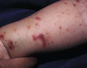 Petechial Rash Case 55 Obgyn Key