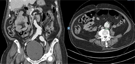 Ct Aortogram Demonstrating The Aortoiliac Aneurysm With Small Amount Of