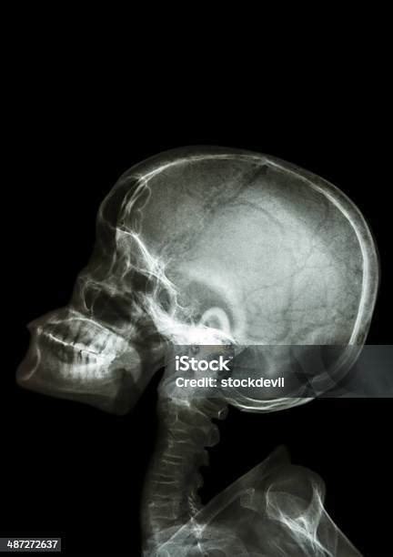 X레이 아시아판 어린이 조회 X 레이에 대한 스톡 사진 및 기타 이미지 X 레이 아기 엑스레이 이미지 Istock