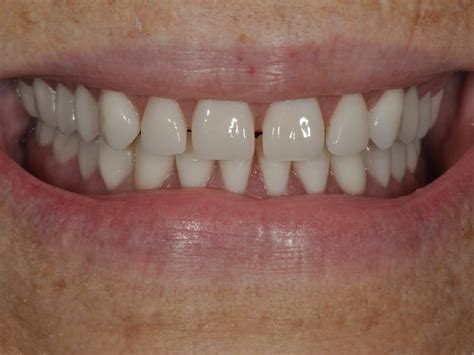 Prótesis Dental Removible sobre Implantes Sonria Atlanta GA