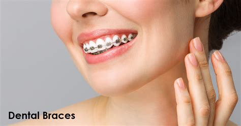 Dental Braces Cost In Saudi Arabia Dental Braces Price In Saudi