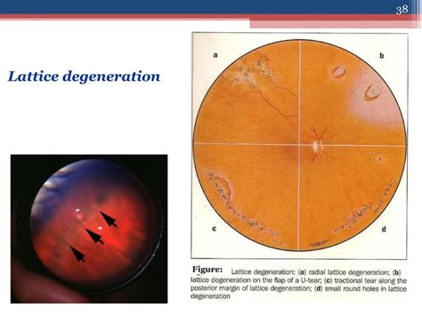 741refractioni And Myopia And Its Treatmentppt
