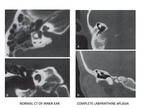 Congenital Malformations Of Inner Earpptx