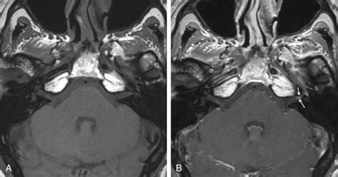 Temporal Bone Inflammatory And Infectious Diseases Radiology Key