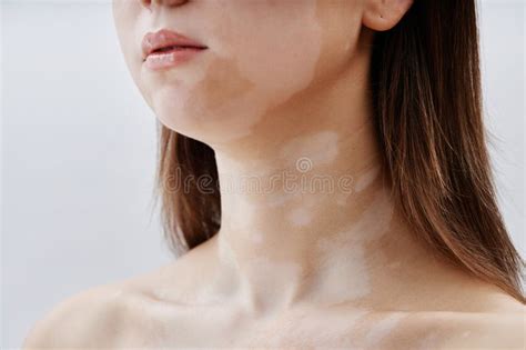 Neck With White Patches In Unique Pattern Of Girl With Vitiligo Posing