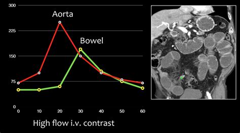 The Radiology Assistant Closed Loop Obstruction With Video