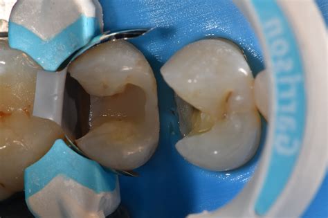 closing large gaps between teeth with strata g