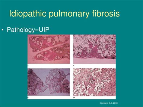Ppt Interstitial Lung Disease Powerpoint Presentation Free Download