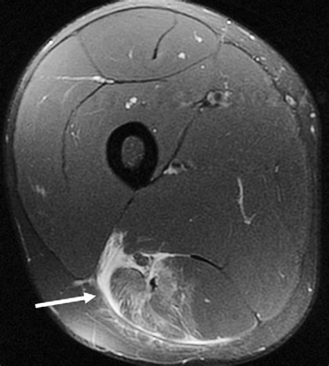 Hamstring Injuries Knee And Sports Orthobullets