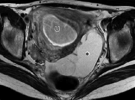 Diagnostic Imaging Of Peritoneal Inclusion Cysts Springerlink
