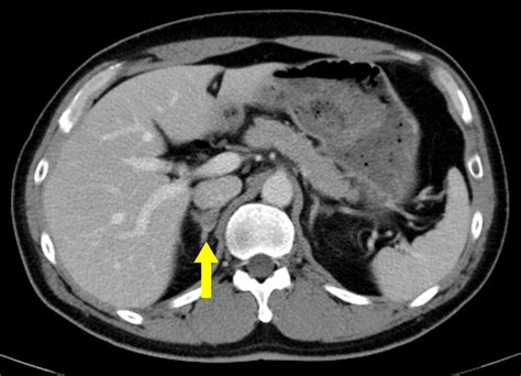 Enhanced Computed Tomography Before Adrenalectomy Right Adrenal