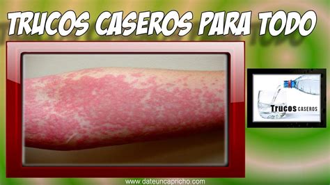 Como Tratar La Urticaria Con Remedios Caseros Naturales Urticaria