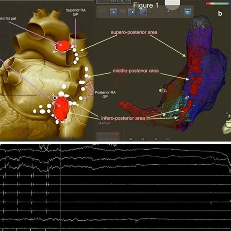 Symptoms Scenario Before And After GP Ablation In The Right Atrium A Download Scientific