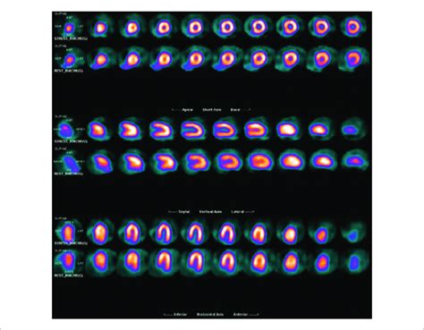 Case 10 Myocardial Perfusion Scintigraphy With Homogenous Download Scientific Diagram