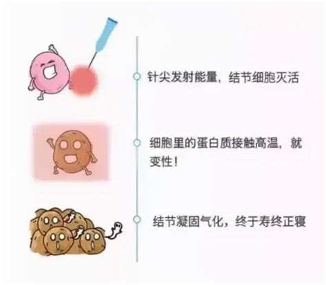 生命滙带你了解搞定甲状腺、乳腺结节的微波消融术凤凰网区域凤凰网