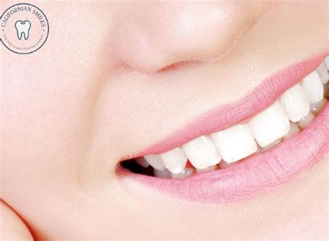 How To Choose The Right Time To Start A Tooth Whitening Treatment