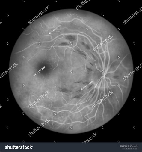 Nonproliferative Diabetic Retinopathy Illustration Showing Flameshaped