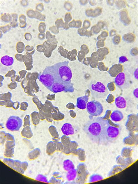 Plasma Cells Multinucleated Form Binucleated Flame Cells Mott Cell Case