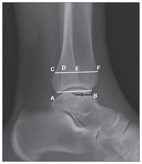 Radiographic Evaluation Of The Ankle Syndesmosis Cjs