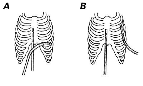 Illustrations Of The A Subxiphoid And B Intercostal Routes Of Download Scientific Diagram