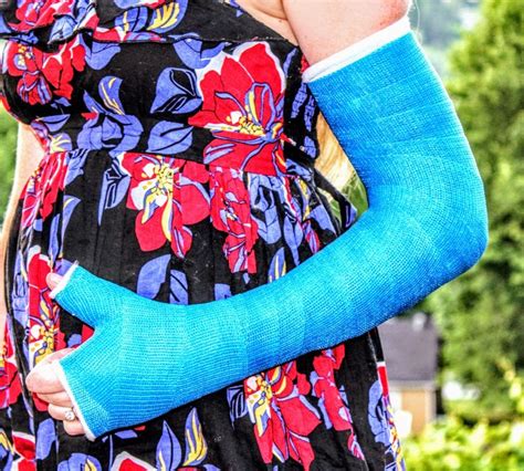 Scaphoid Fracture Full Arm Cast In 2022 Arm Cast It Cast Scaphoid