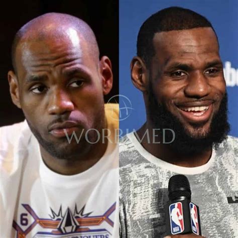 Lebron James Hair Transplant L Before And After